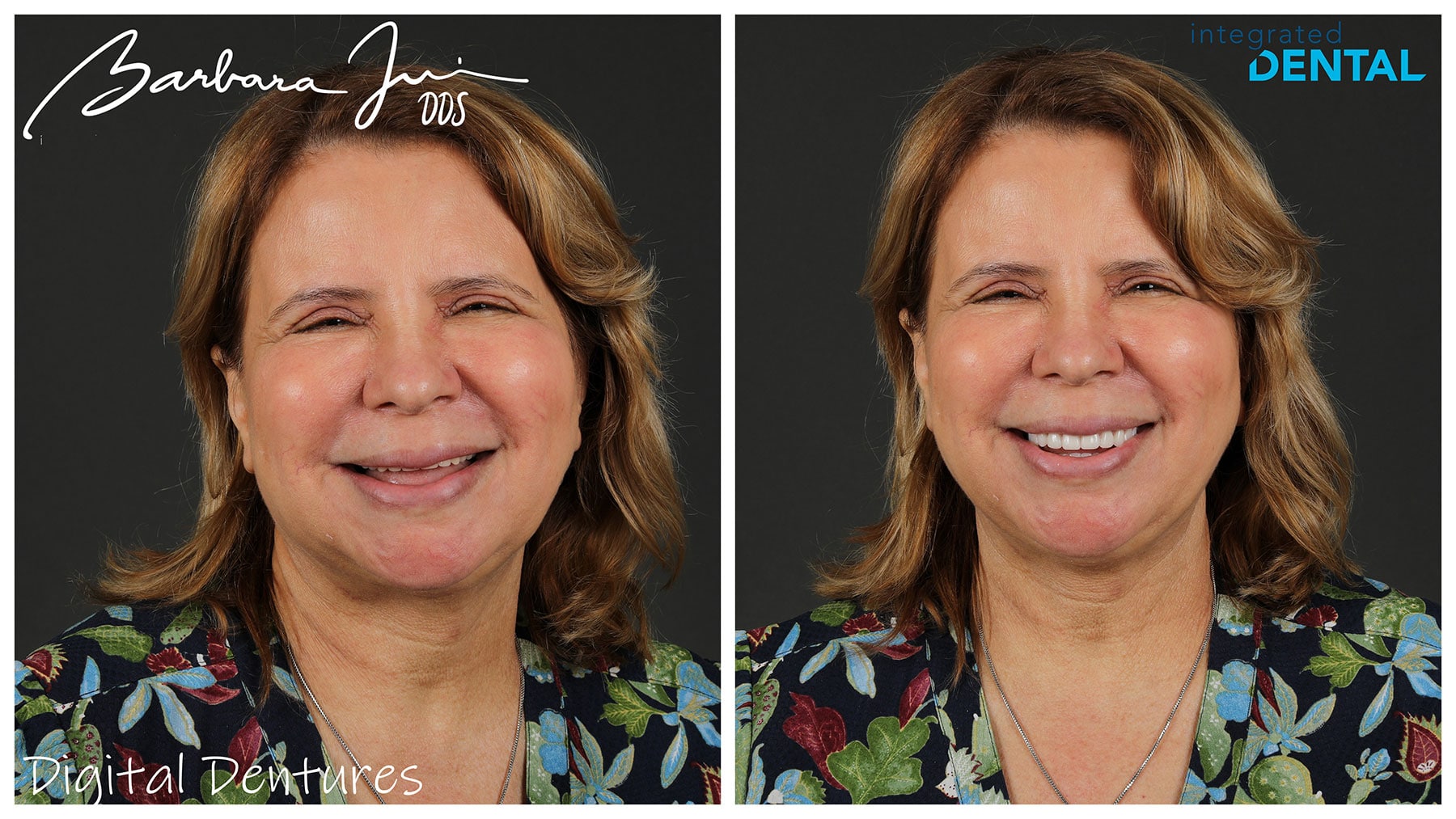 Custom Fit Dentures for a Comfortable and Natural Smile